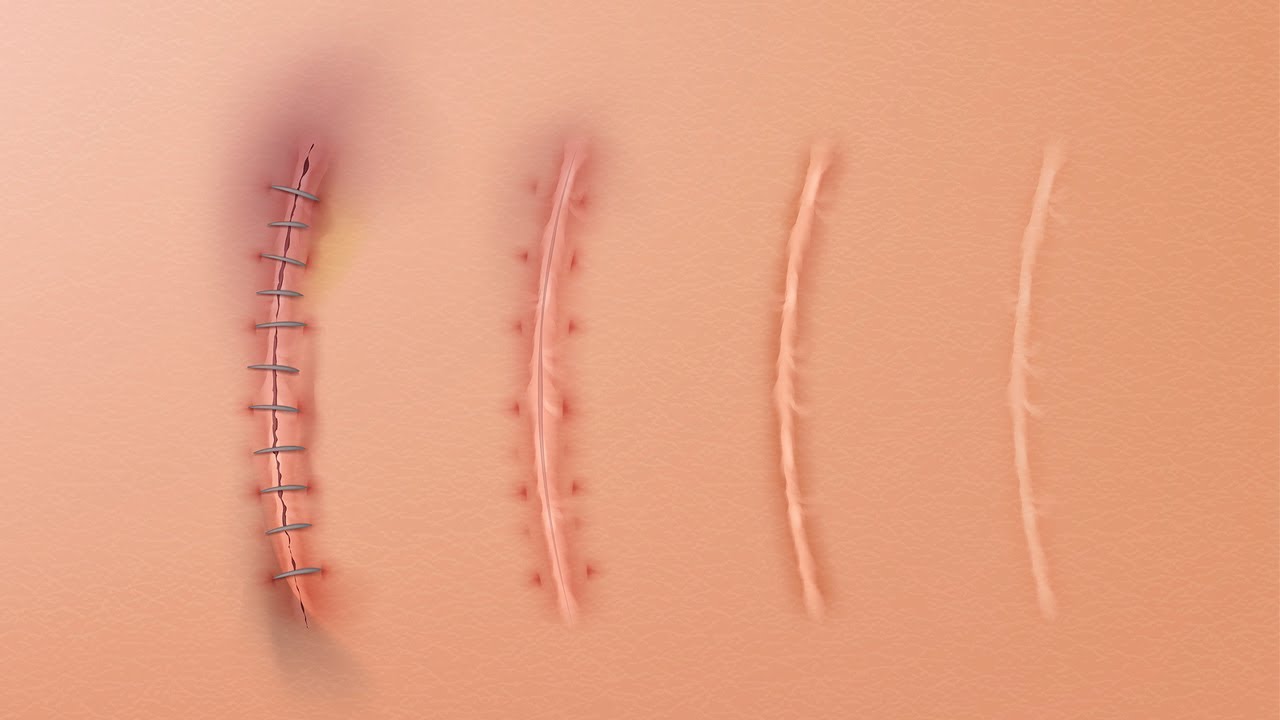 How to Prevent and Fade Scars Naturally - YouTube