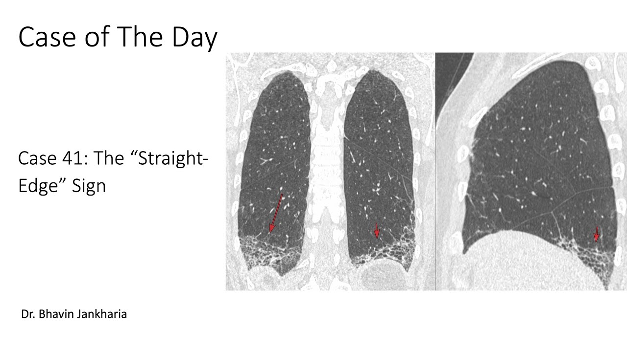 Case of the Day - 041 - 2025 05 27 - The "Straight-Edge" Sign - YouTube
