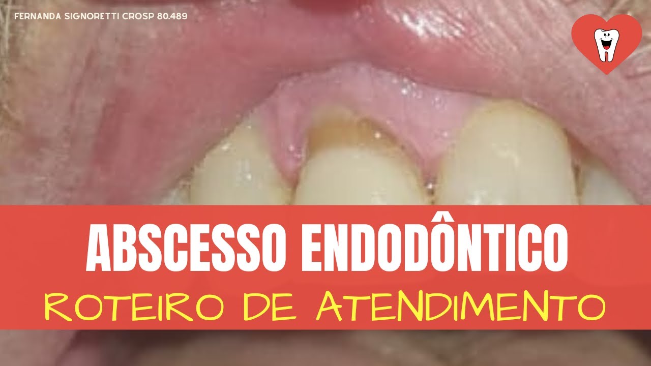 [ROTEIRO COMPLETO] TOMADA DE DECISÃO CLÍNICA EM ABSCESSO ENDODÔNTICO ...