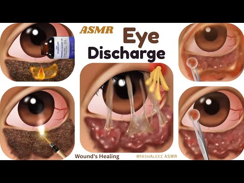 ASMR | Sticky Eye Discharge Removal👁️| Eye Gunk Cleanup👀| Eye Mucus ...