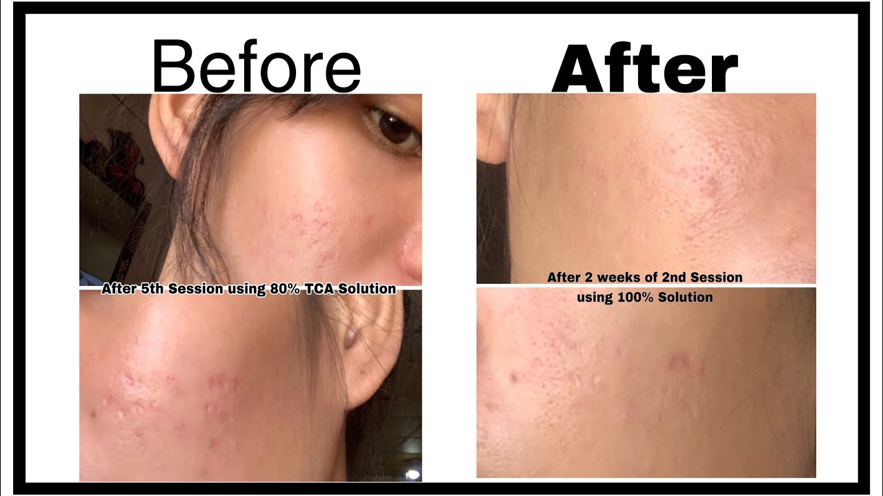 DIY TCA CROSS | Before and After Result - Update - YouTube