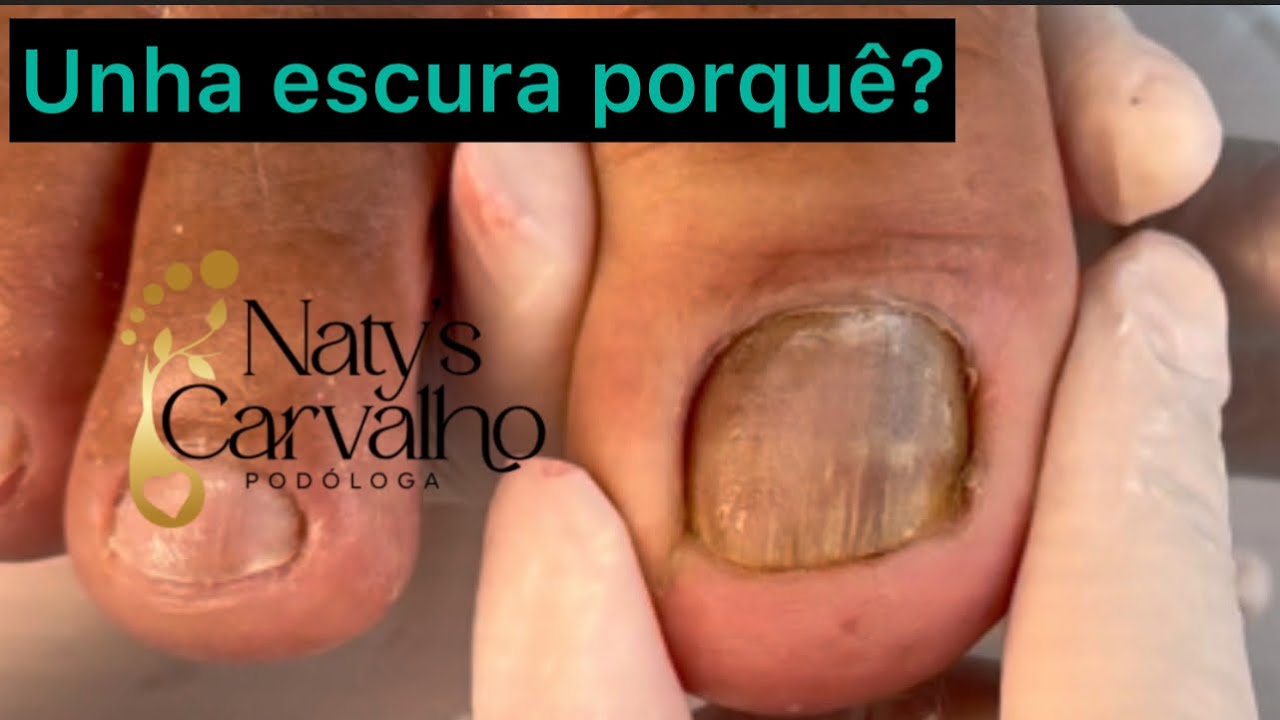 Unhas escuras porque isso acontece? - YouTube