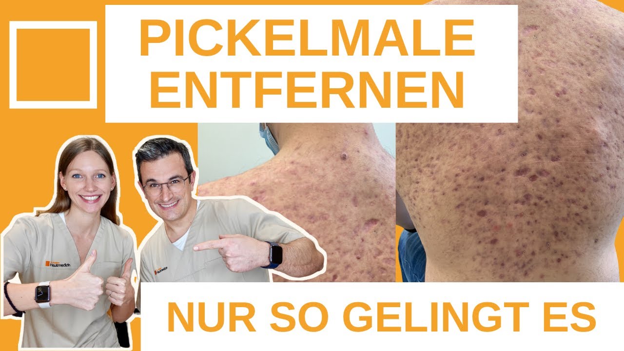 Pickelmale im Gesicht, Dekollete, Rücken und Oberarme entfernen - YouTube