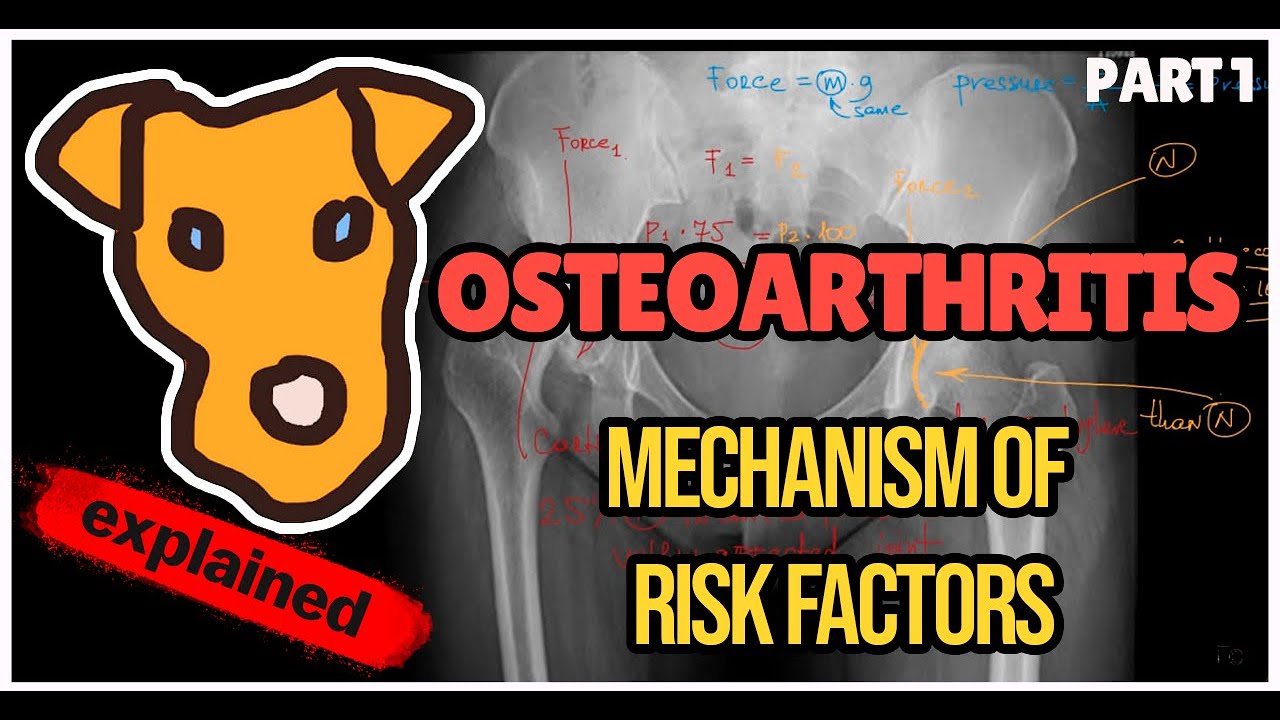 OSTEOARTHRITIS Pathogenesis of Risk Factors - YouTube