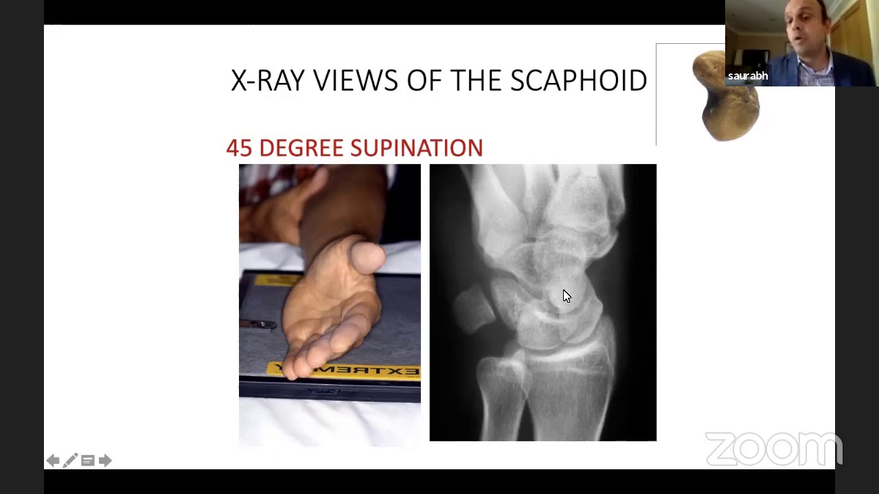 Scaphoid fracture and SNAC wrist by Dr Saurabh Aggarwal - YouTube