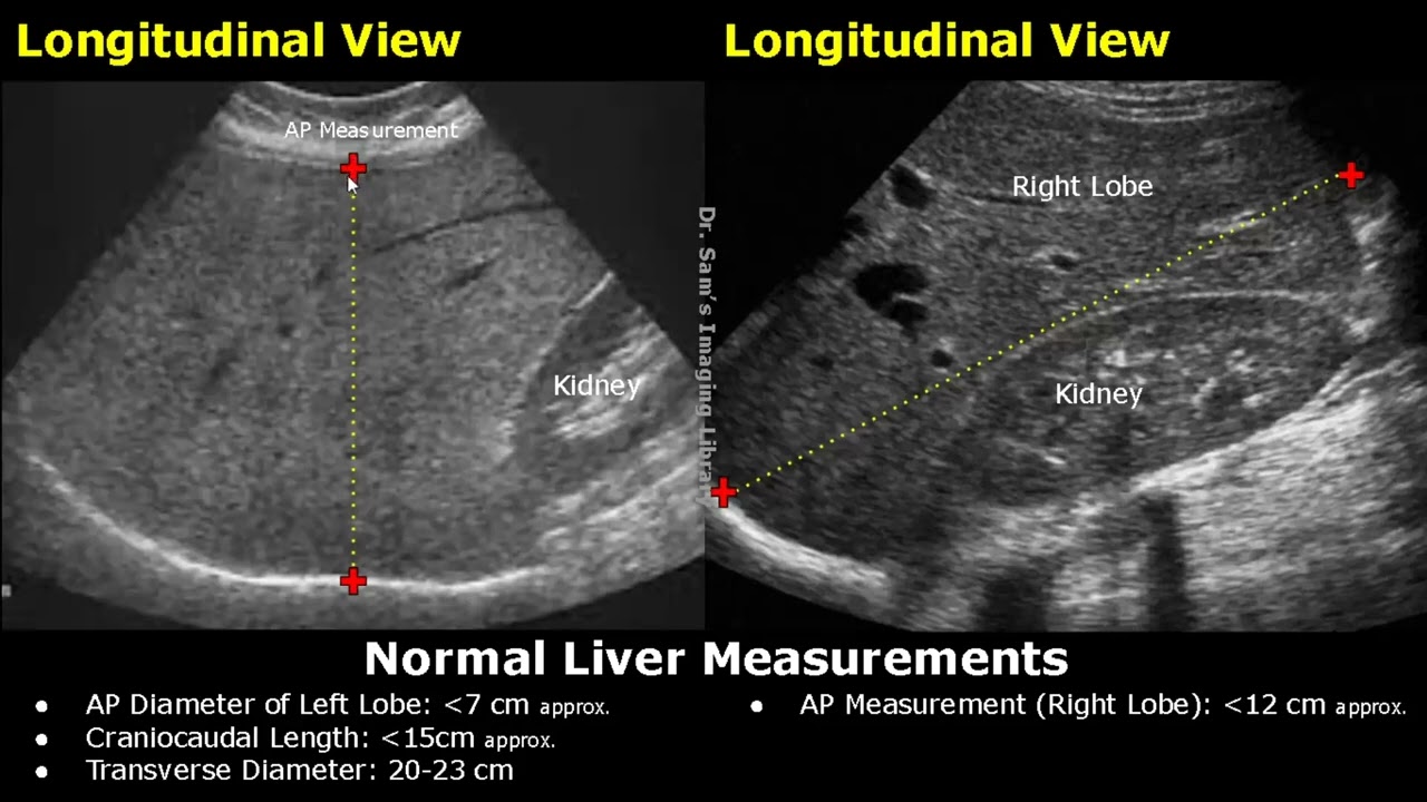 How To Measure Liver On Ultrasound Craniocaudal Length Transverse How To Measure Liver On Ultrasound Craniocaudal Length Transverse