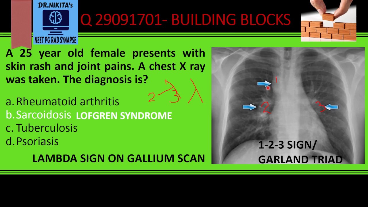 SARCOIDOSIS- Chest X ray- 1-2 -3 sign - YouTube
