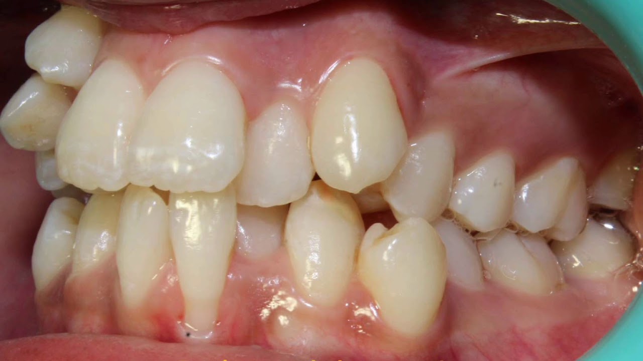 T Loop mechanics, Canine retraction, lower incisor extraction # ...