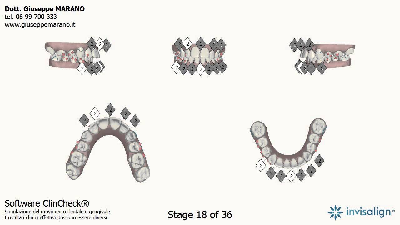 ClinCheck® Invisalign® - YouTube