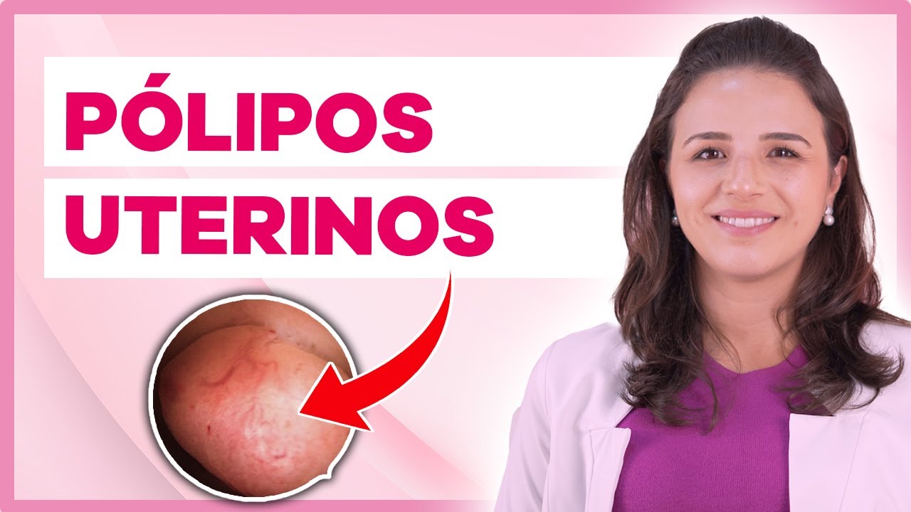 Pólipo Endometrial é Perigoso Vídeo Com Retirada De Pólipo Youtube