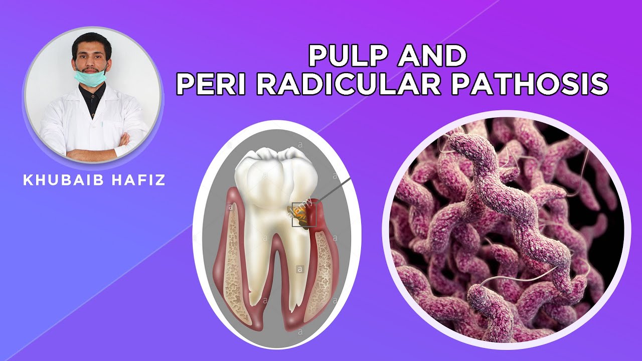 Pulp and Periradicular pathosis. - YouTube