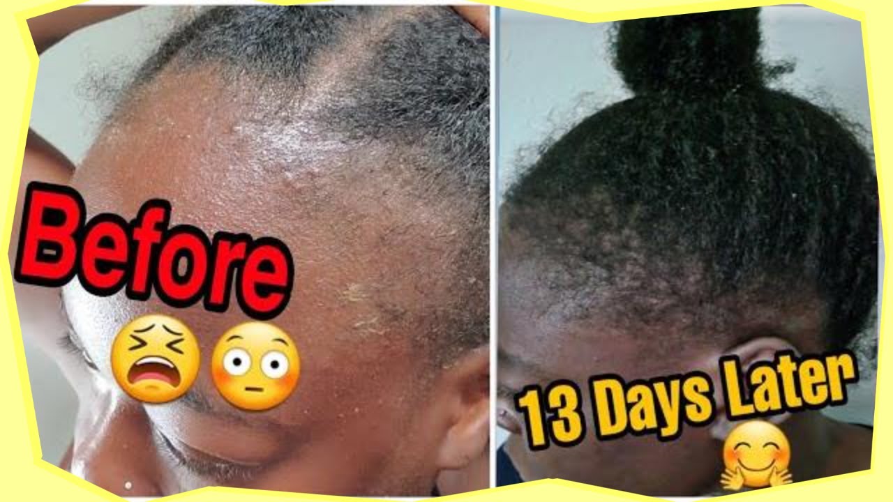 Grow Your Edges Back Super Fast | Grow Natural Hair In 2 Weeks | Real ...