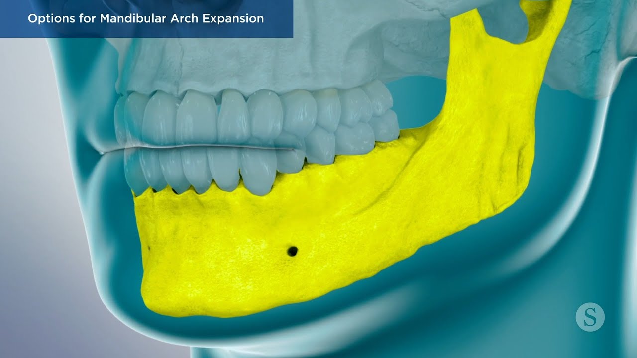 Options for Mandibular Arch Expansion - YouTube