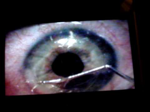 Lasix eye surgery 8/3/09 - YouTube