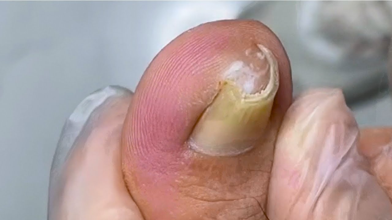 Extremely curly nails are trimmed - YouTube