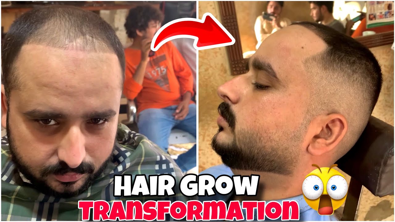 Amazing Hair growth transformations: Latest buzz hair style for men’s ...