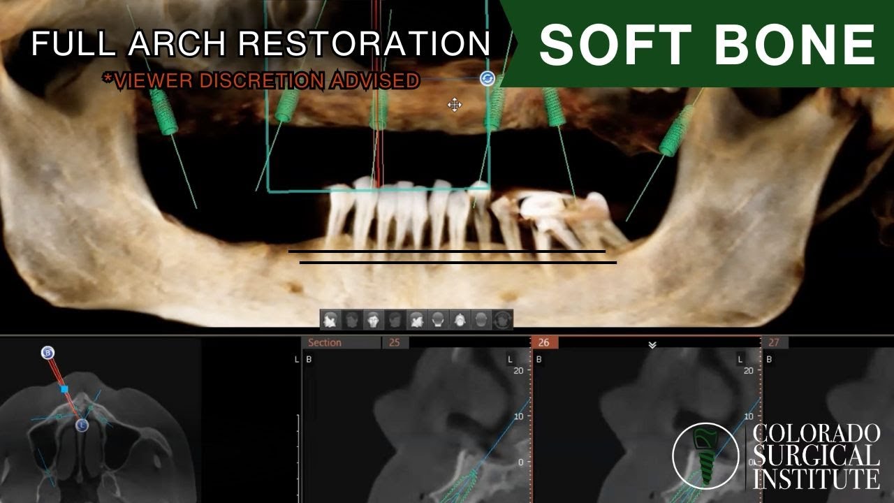 Soft Bone Implant Protocol for Full Arch Reconstruction - YouTube