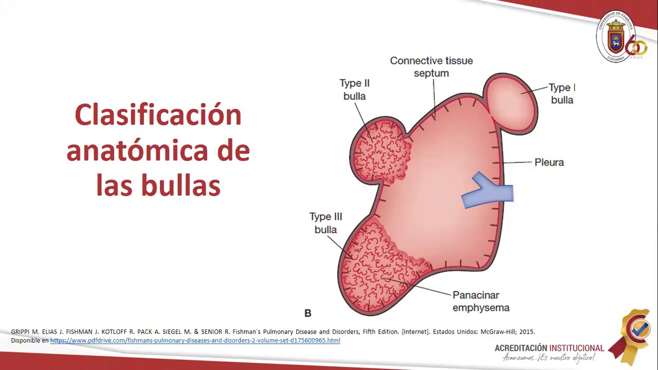 SEMINARIO: “ENFERMEDAD BULOSA PULMONAR, ENFOQUE QUIRÚRGICO” Estudiantes ...