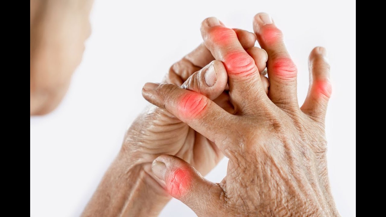 Rhematoind Arthritis by Abitegeka Derrick - YouTube