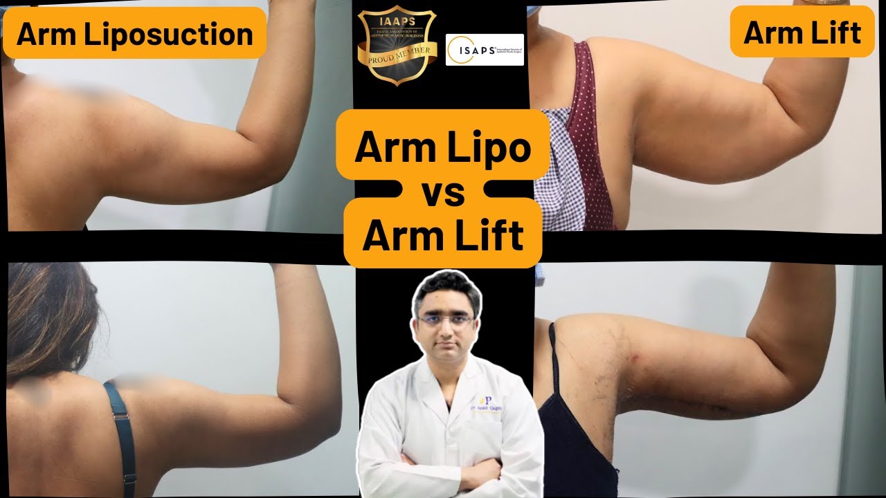 Arm Lift or Liposuction? Difference Between Arm Lift and Arm ...