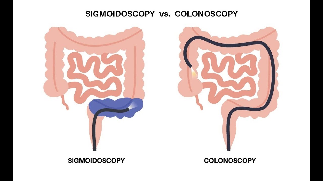 Differences between Sigmoidoscopy and Colonoscopy - YouTube