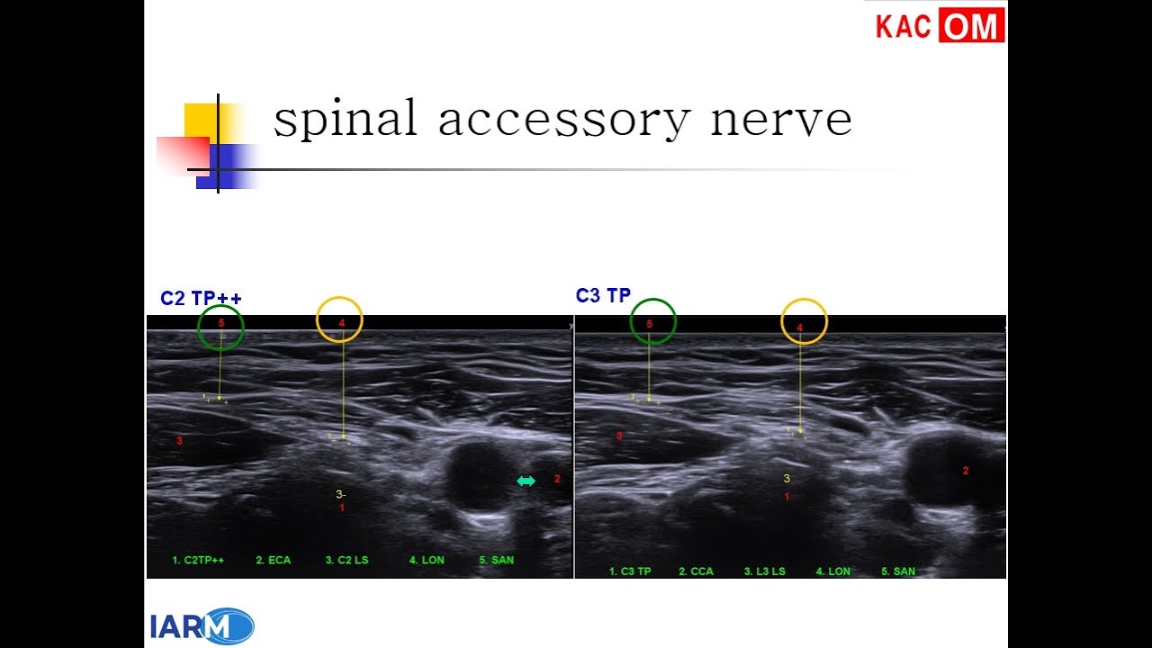 spinal accessory nerve type II - YouTube
