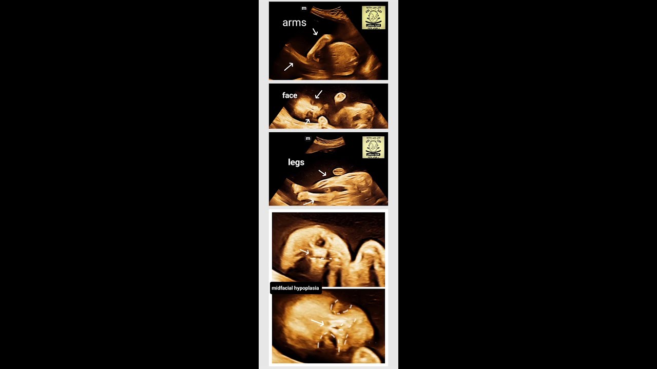 fetal akinesia/hypokinesia sequence joint contractures, midfacial ...