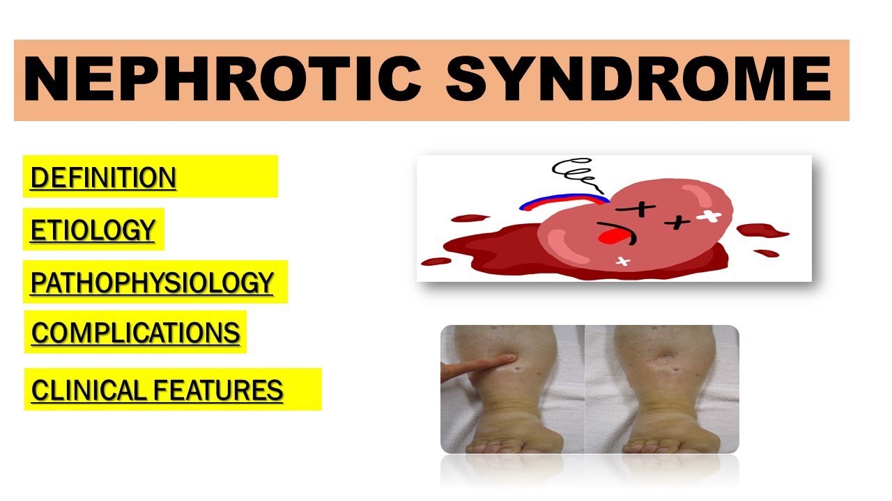 Nephrotic Syndrome | Simplified Overview | Made easy. - YouTube