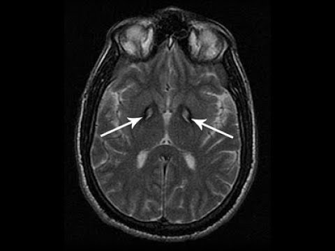 NBIA(Neurodegeneration with Brain Iron Accumulation )HINDI - YouTube