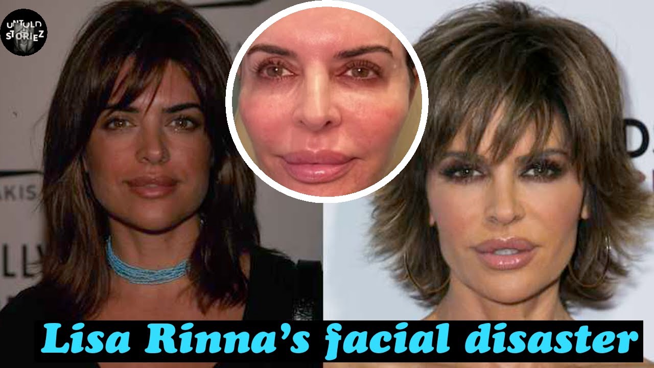 Lisa Rinna reacts to criticism of her 'new face' after botched facial ...