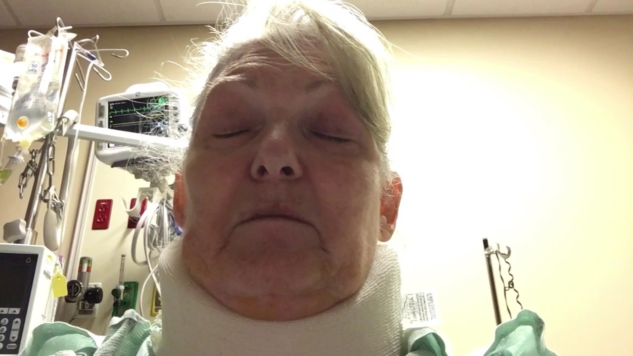 ACDF C4-C7 Post Op Day 1 - YouTube