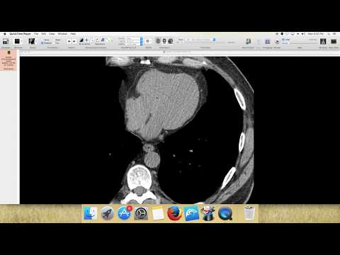 How to Score a Calcium Score Under CT Radiology