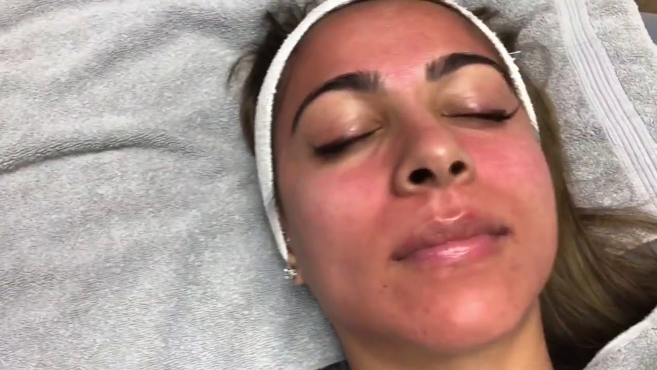 Sublative Resurfacing with PRP - YouTube
