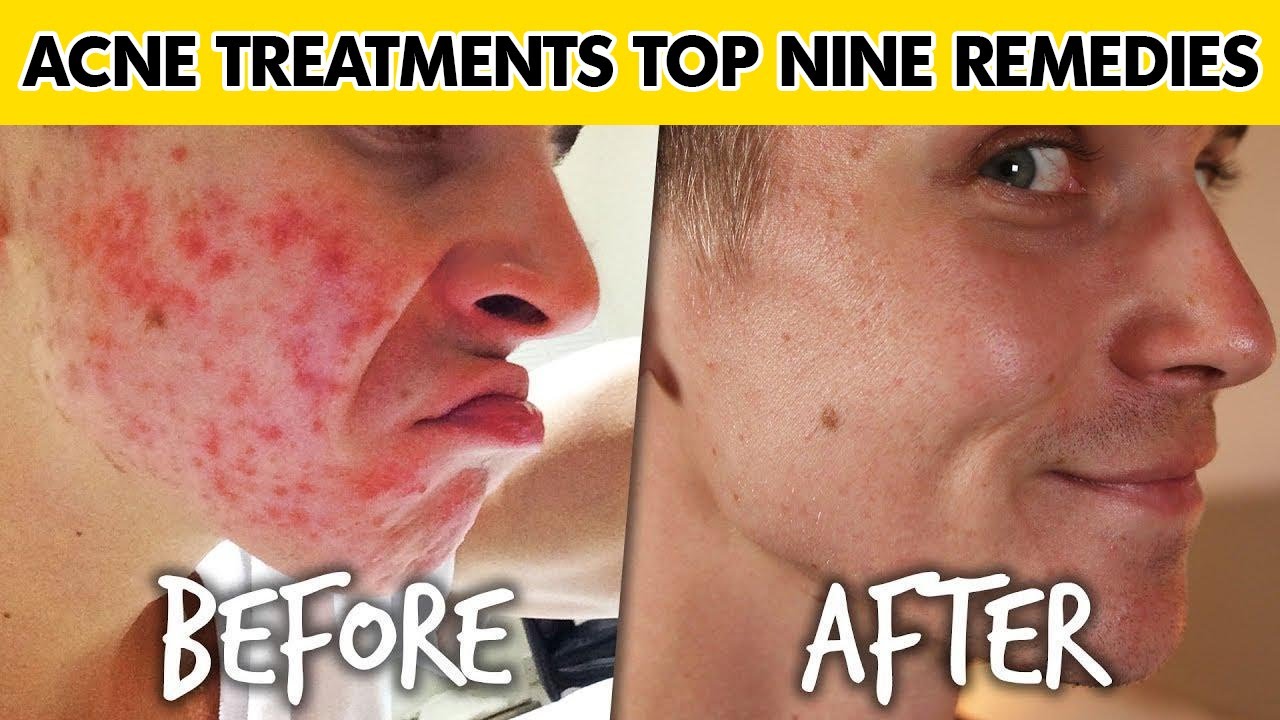 Loan Nguyen Acne Treatment