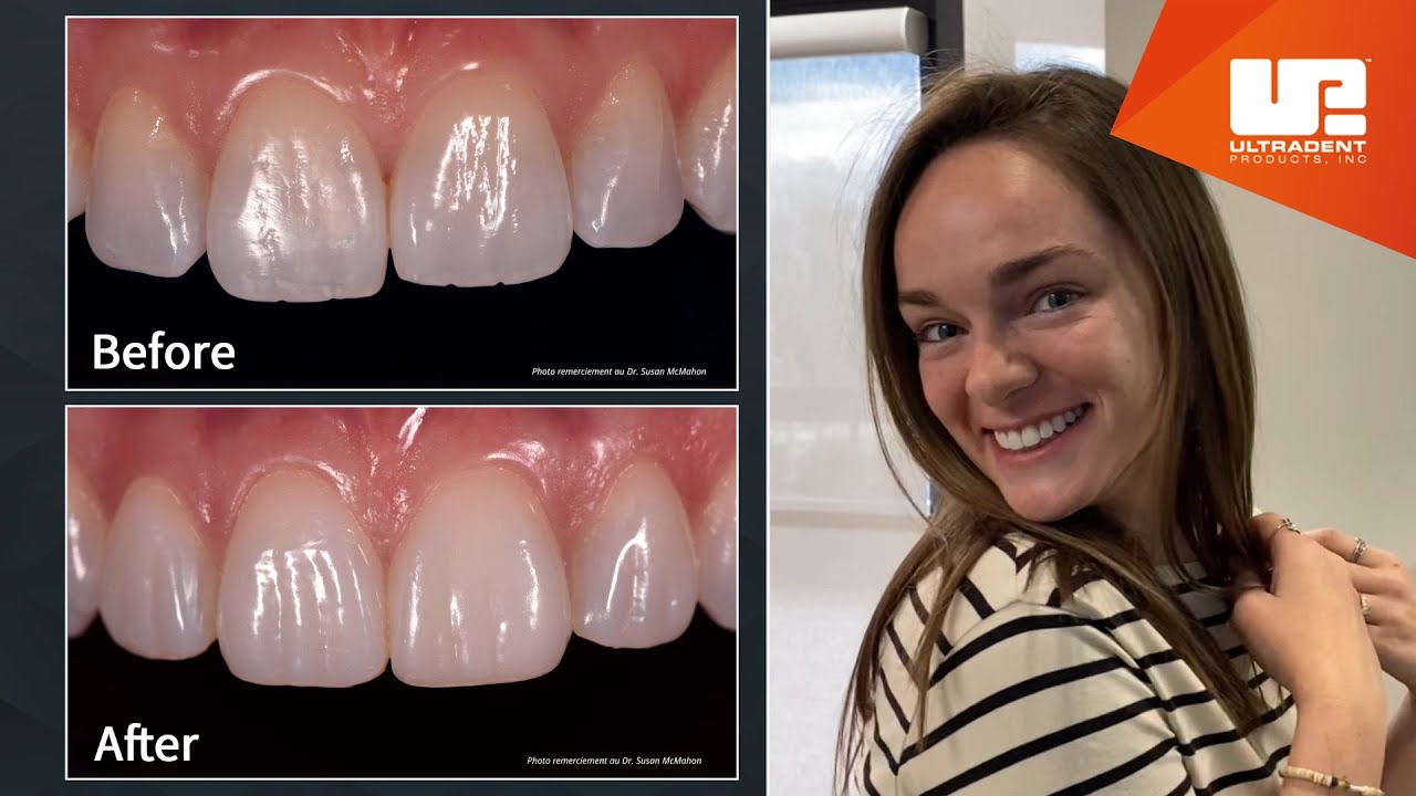 Uveneer® and Uveneer® Extra | Direct Veneer Template System (EU) - YouTube