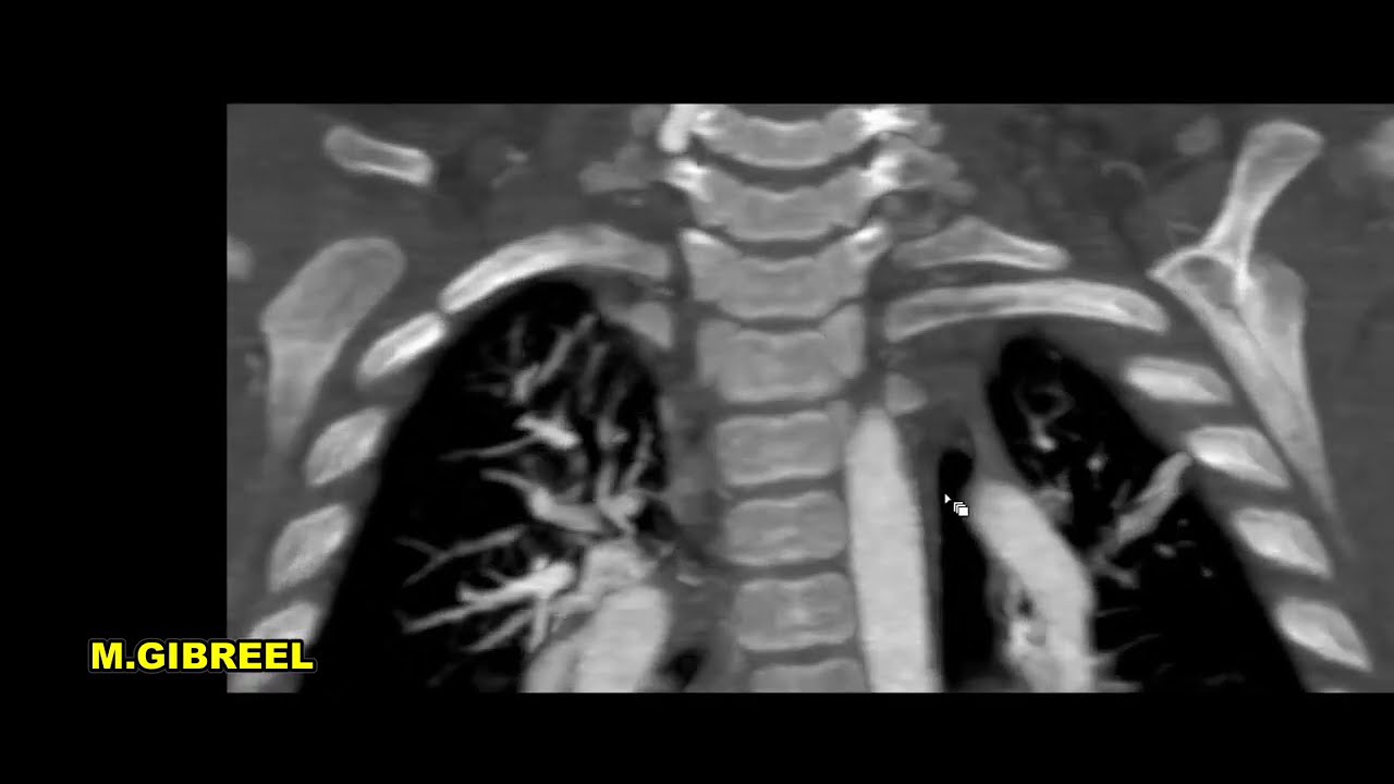 Two types of circumflex aortic arch,,From my archive - YouTube
