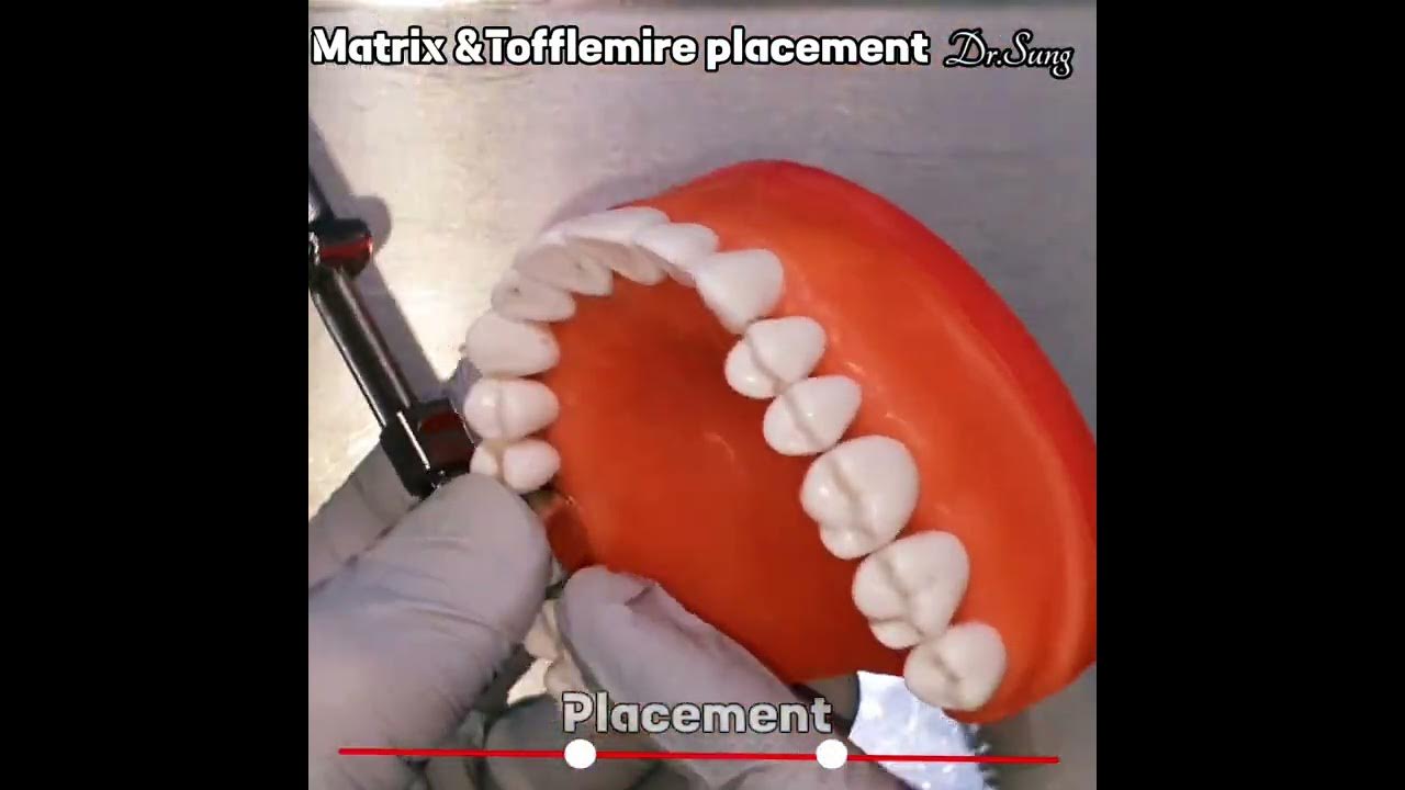 Matrix band and Tofflemire and wedge placement - YouTube