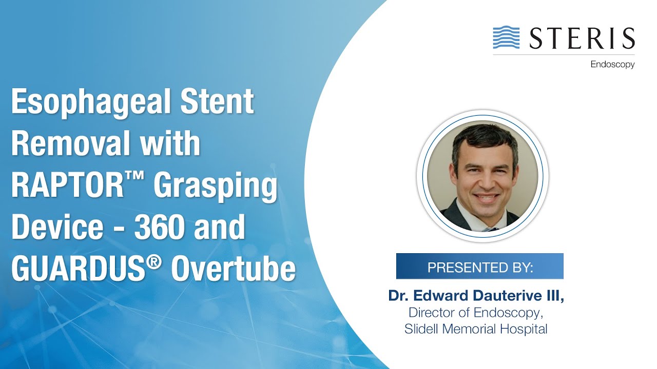 Esophageal Stent Removal with RAPTOR™ Grasping Device – 360 Rat-Tooth ...