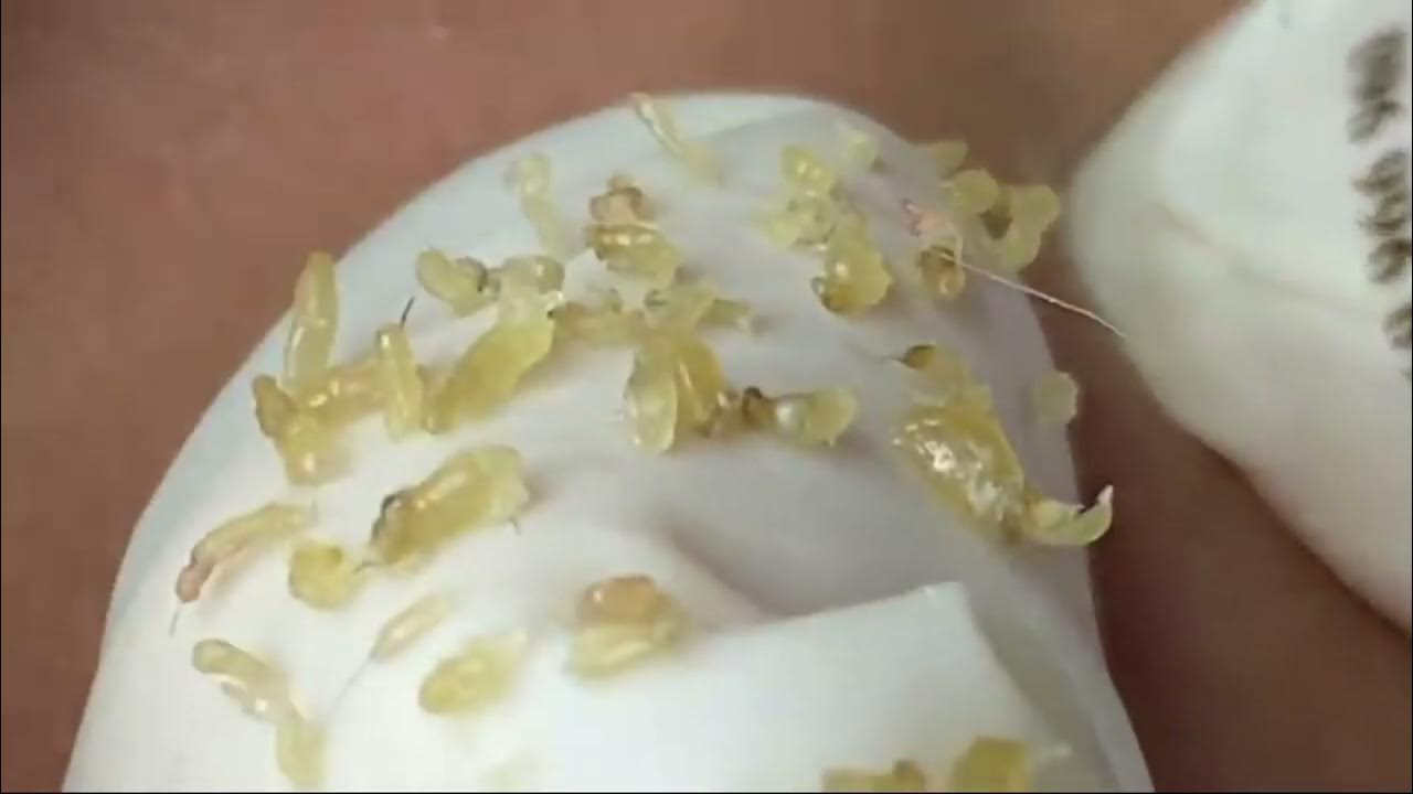 Relax Every Day With Sac Dep Spa Blackhead Removal Blackhead Spa 2022 Acne Treatment Youtube