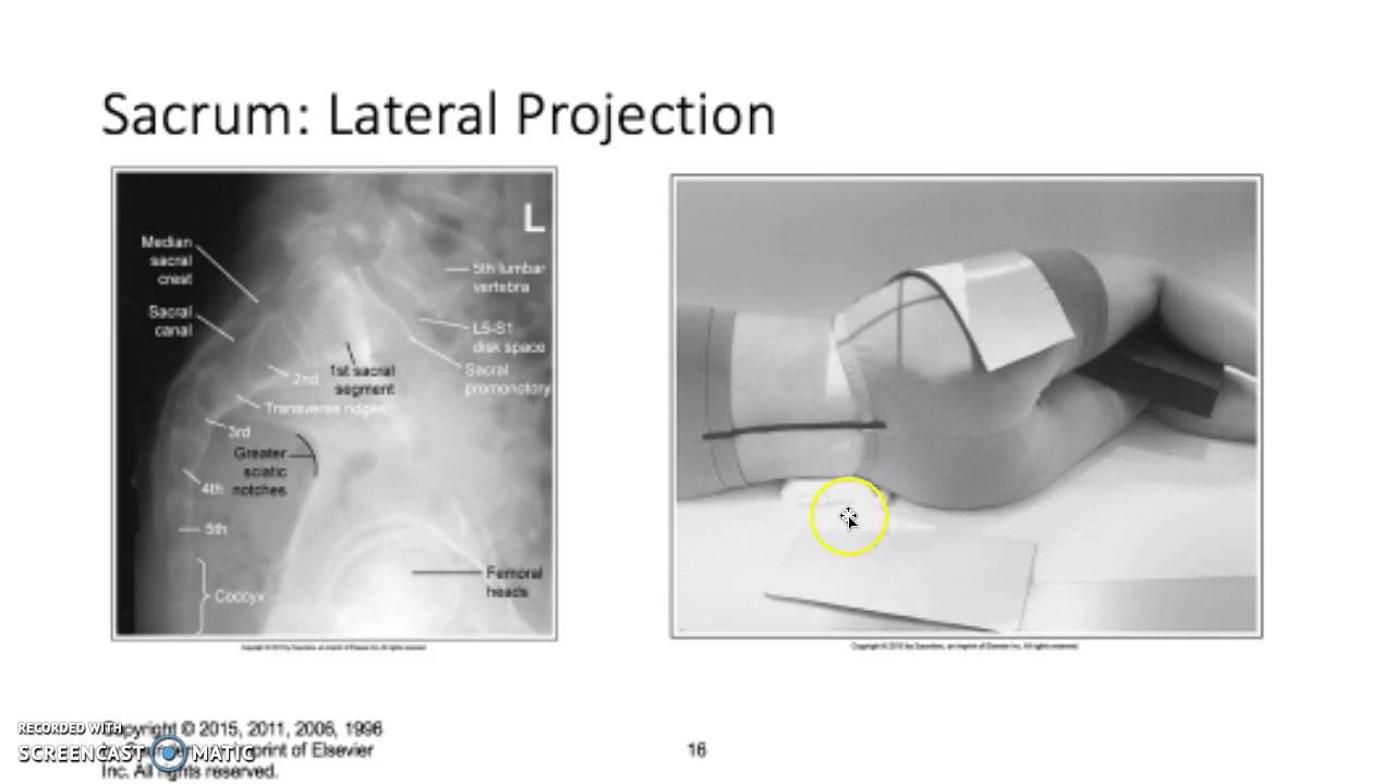 Sacrum/coccyx part 2 - YouTube