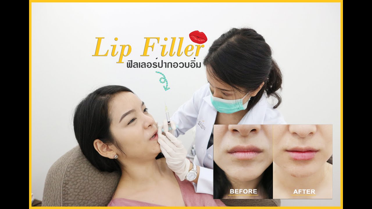 L Clinic Beauty Center - LIP Filler (ฟิลเลอร์ปาก) โดยคุณหมออร - YouTube