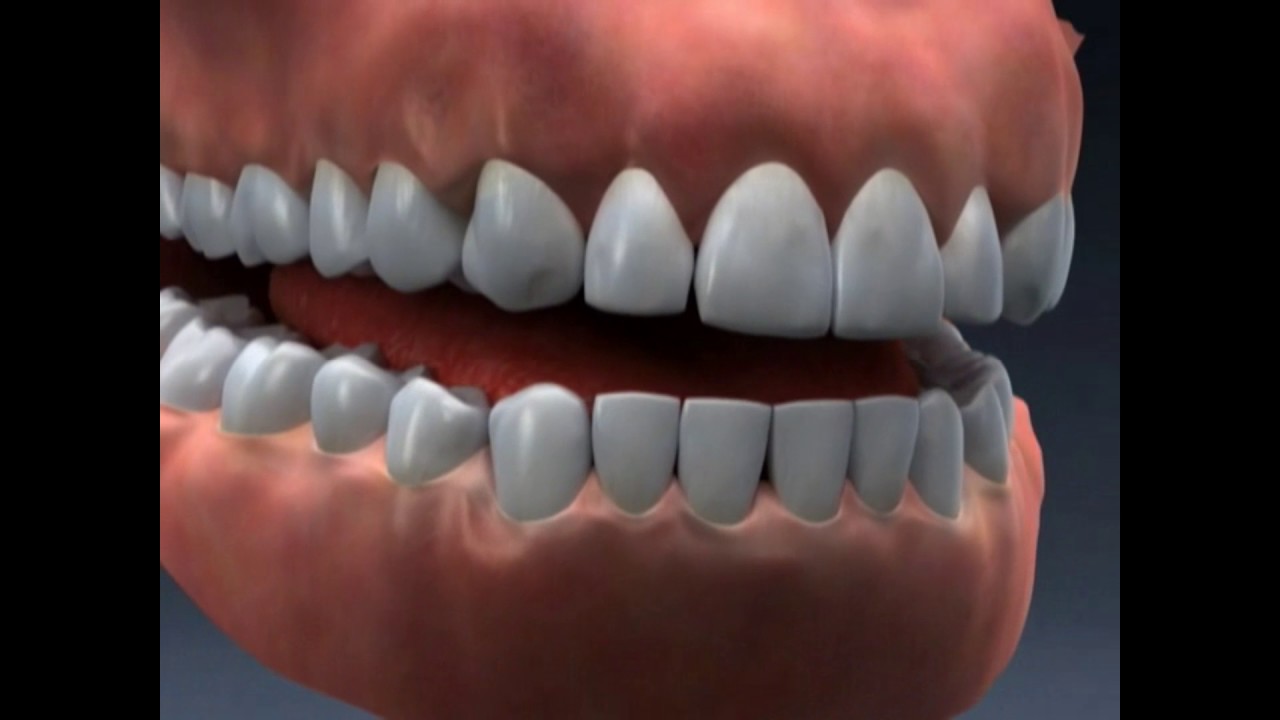 Abfraction | Lake Merritt Dental, Oakland, CA - YouTube
