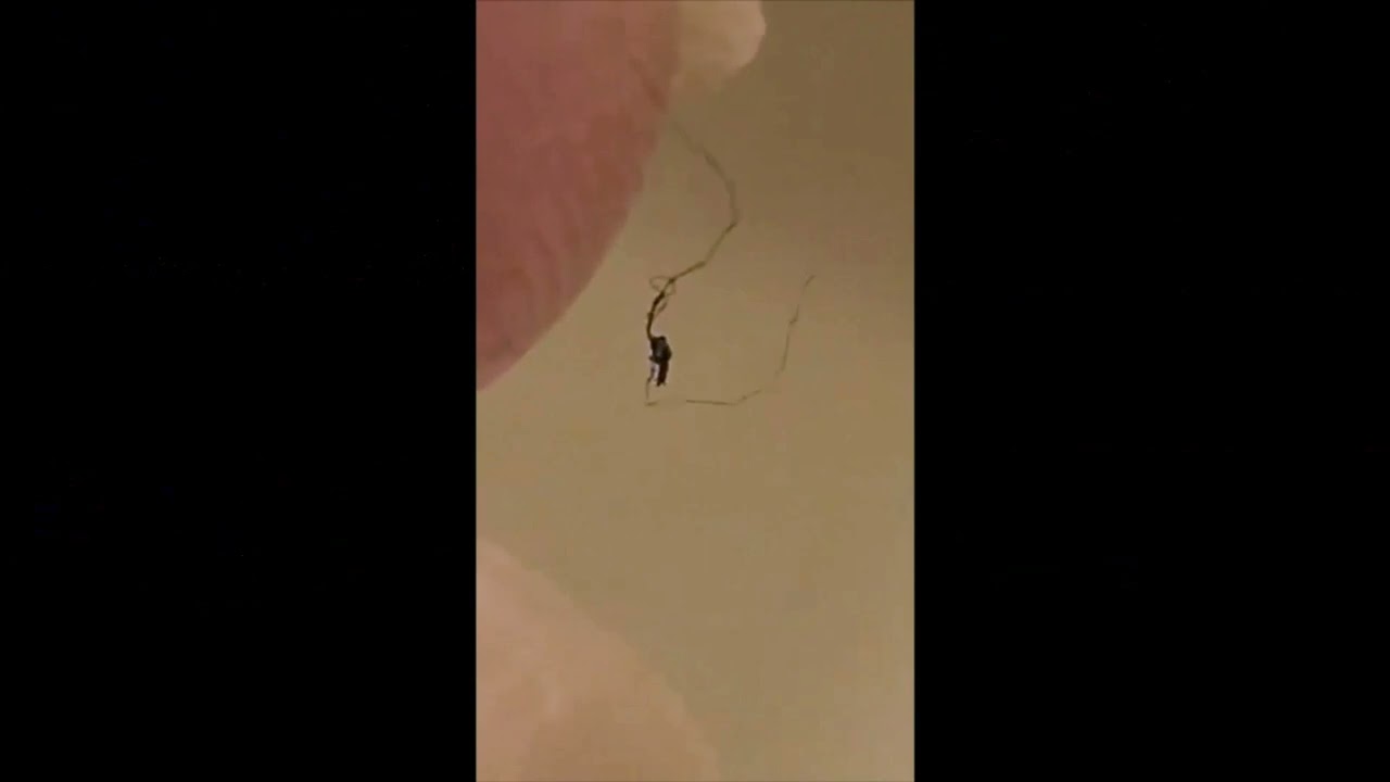 Morgellons Disease: Parasitic Skin Infestation with Larvae and Flippi ...