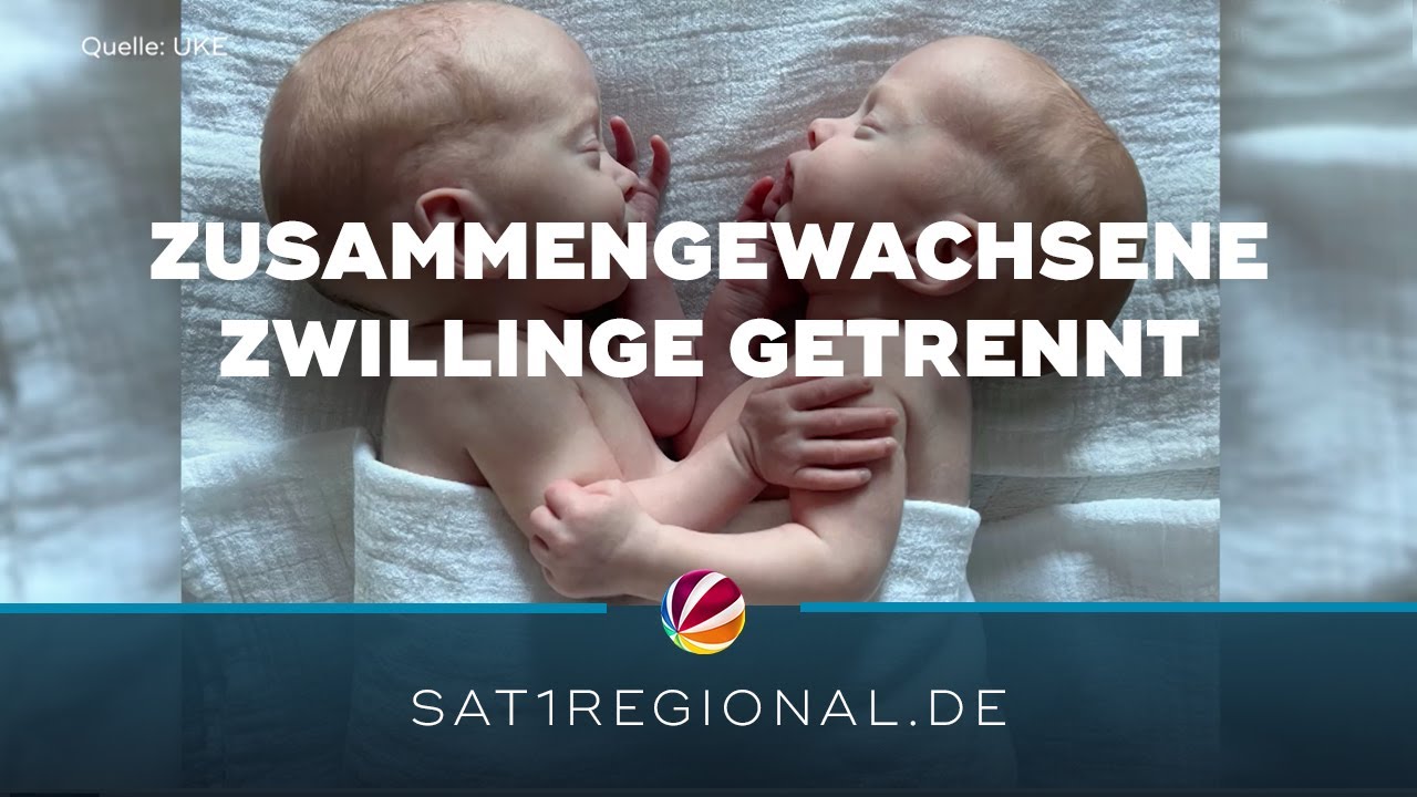 Zusammengewachsene Zwillinge erfolgreich am UKE in Hamburg getrennt ...