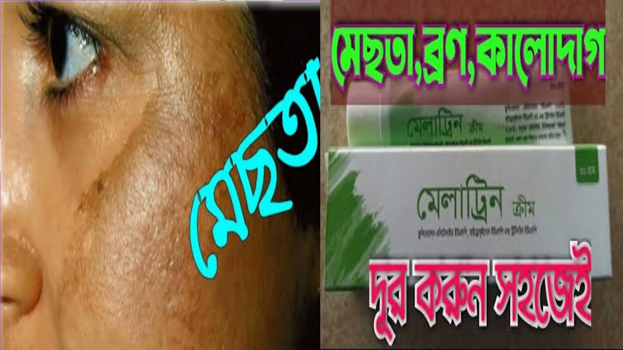 melatrin cream/ মেছতা,মুখের ব্রন, কালো দাগ , দুর করার ৯৯% উপকারী ক্রীম ...