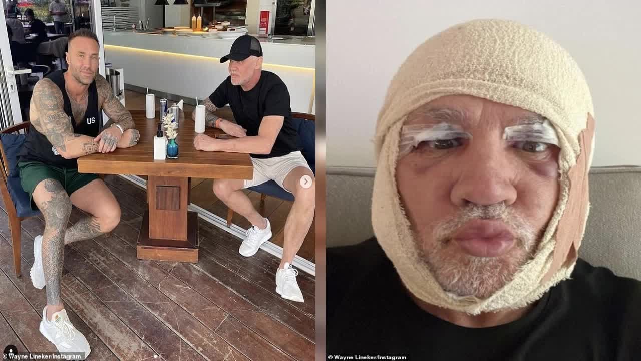 Wayne Lineker, 59, displays two black eyes and swollen face while ...