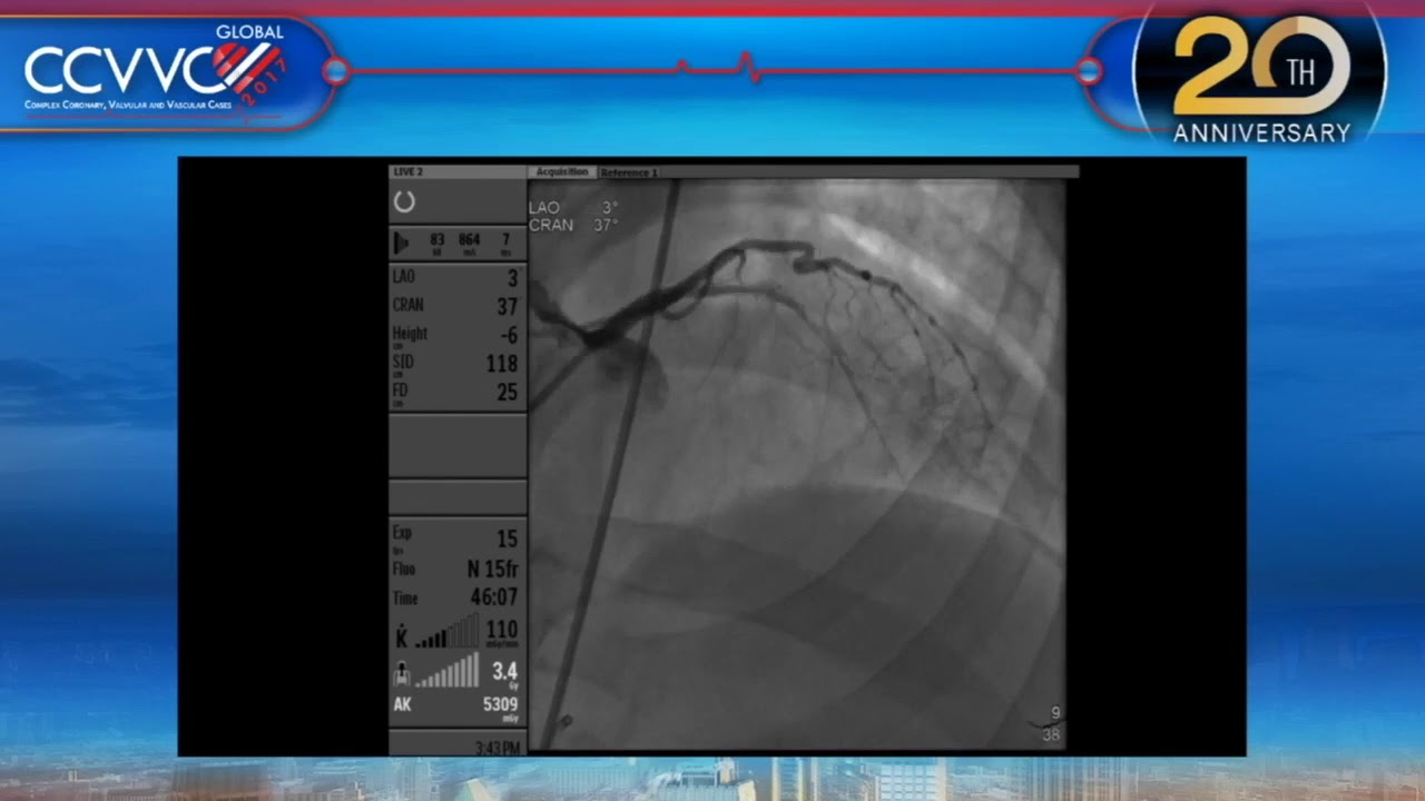 Live Case 11 - PCI of Chronic CTO of mid LAD/Diagonal Bifurcation ...