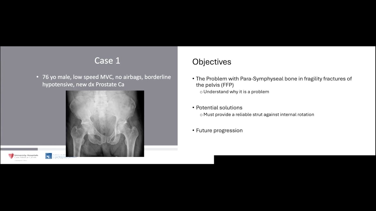 Curved Corridors: Anterior and Combined Anterior and Posterior FX - YouTube