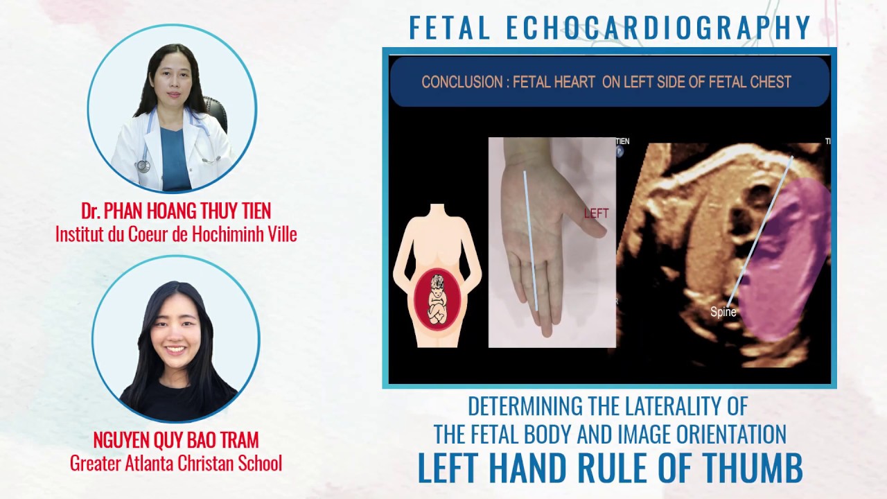 DETERMINING THE LATERALITY OF THE FETAL BODY - LEFT HAND RULE OF THUMB ...