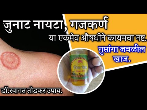 रात्री हे लोशन लावा, नायटा,गजकर्ण, गुप्तांगाजवळची खाज सकाळपर्यंत गायब ...